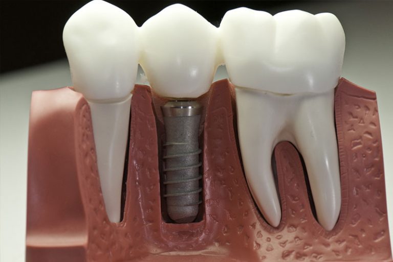 Dentist in Glen Allen, VA | Dental Implants & Implant-Supported Restorations